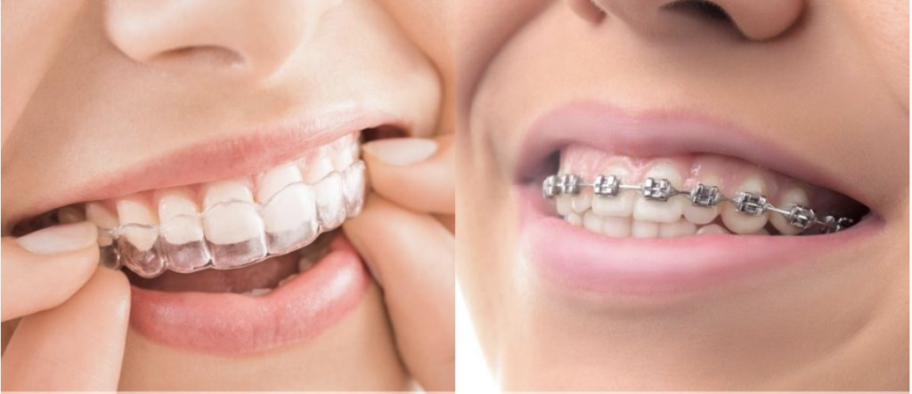 Braces Vs Invisalign What Are The Differences
